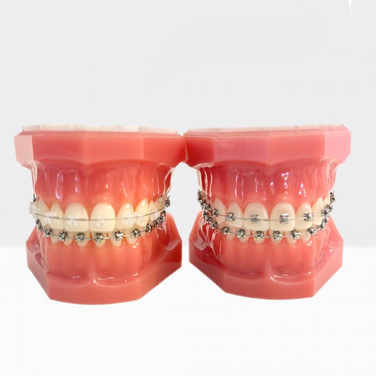 wie Du Deine perfekte Zahnspange findest