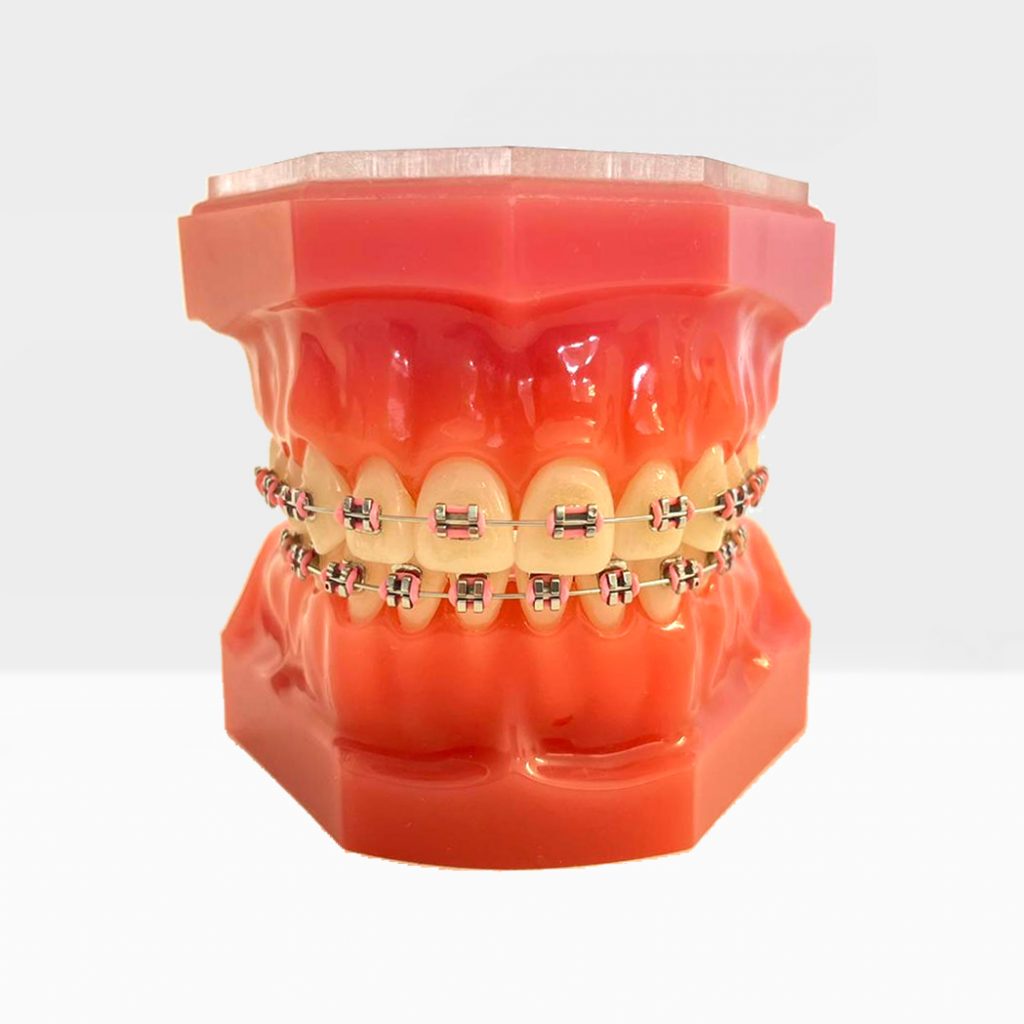 Feste Zahnspange - KFO Eckernförde