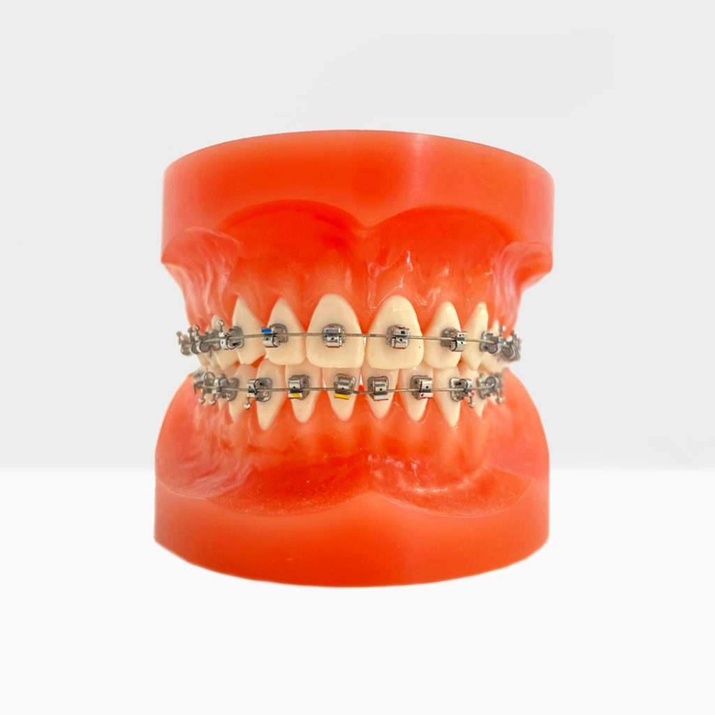 Feste Zahnspange - KFO Eckernförde