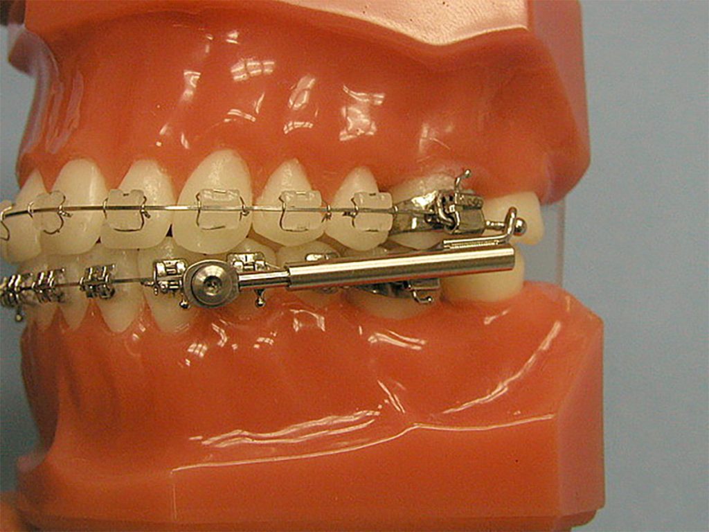 Zusatzapparaturen - Fachpraxis für Kieferorthopädie Eckernförde