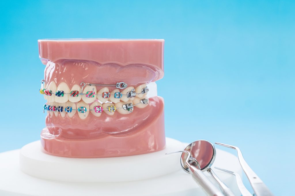 Zusatzapparaturen - Fachpraxis für Kieferorthopädie Eckernförde